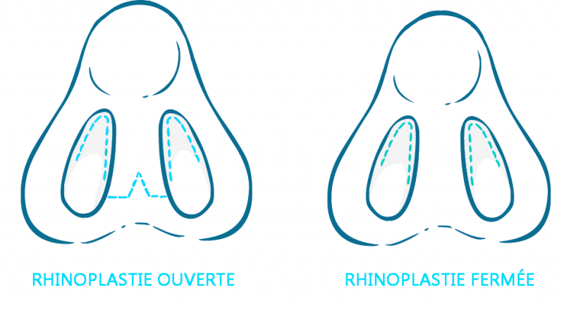 Les voies d'abord de la rhinoplastie : technique ouverte ou fermée